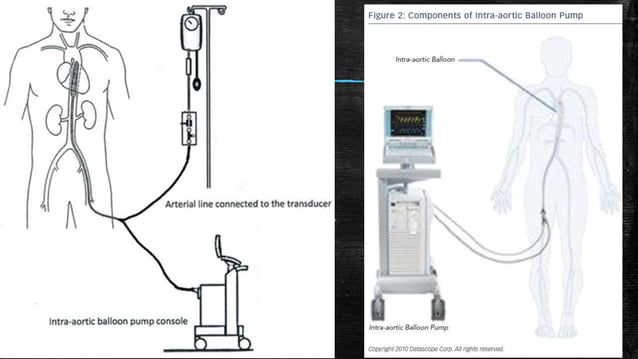 Overview of Intra-Aortic Balloon Pump (IABP) | PPTX | Heart and ...