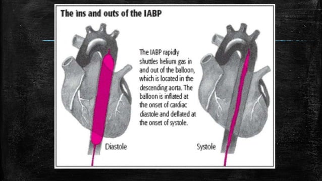 Overview of Intra-Aortic Balloon Pump (IABP) | PPTX | Heart and ...
