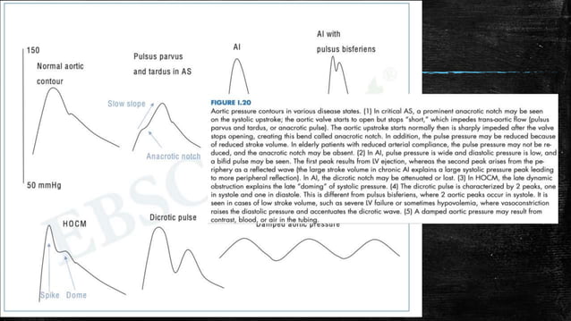 Overview of Intra-Aortic Balloon Pump (IABP) | PPTX | Heart and ...