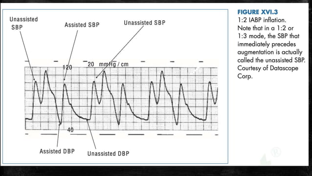 Overview of Intra-Aortic Balloon Pump (IABP) | PPTX | Heart and ...