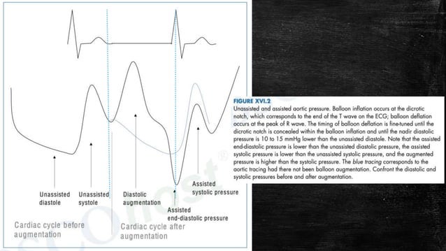 Overview of Intra-Aortic Balloon Pump (IABP) | PPTX | Heart and ...