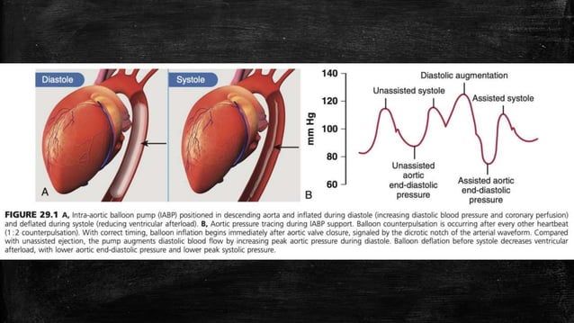 Overview of Intra-Aortic Balloon Pump (IABP) | PPTX | Heart and ...