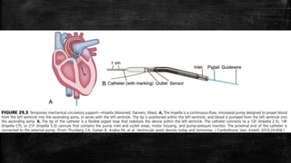 Intra Aortic Balloon Pump Animation