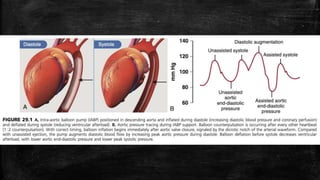 Intra Aortic Balloon Pump Animation
