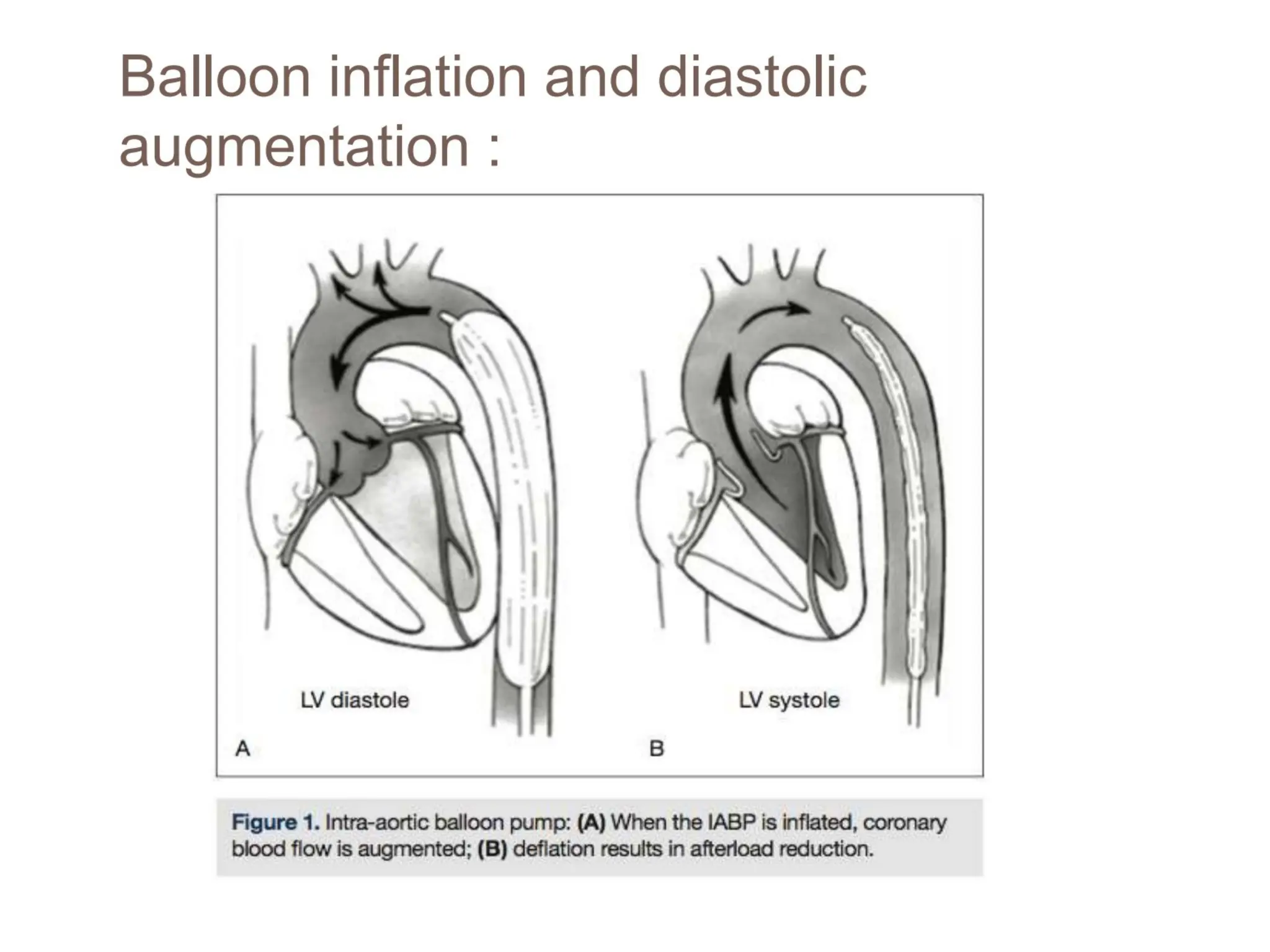 APPROACH TO INTRA AORTIC BALLOON PUMP.ppt