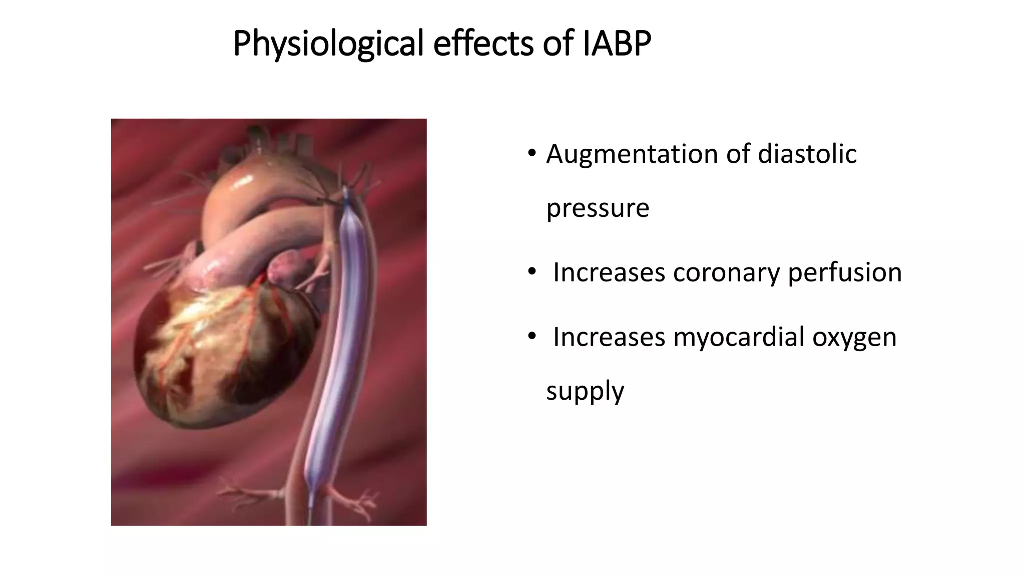 Iabp presentation | PPTX