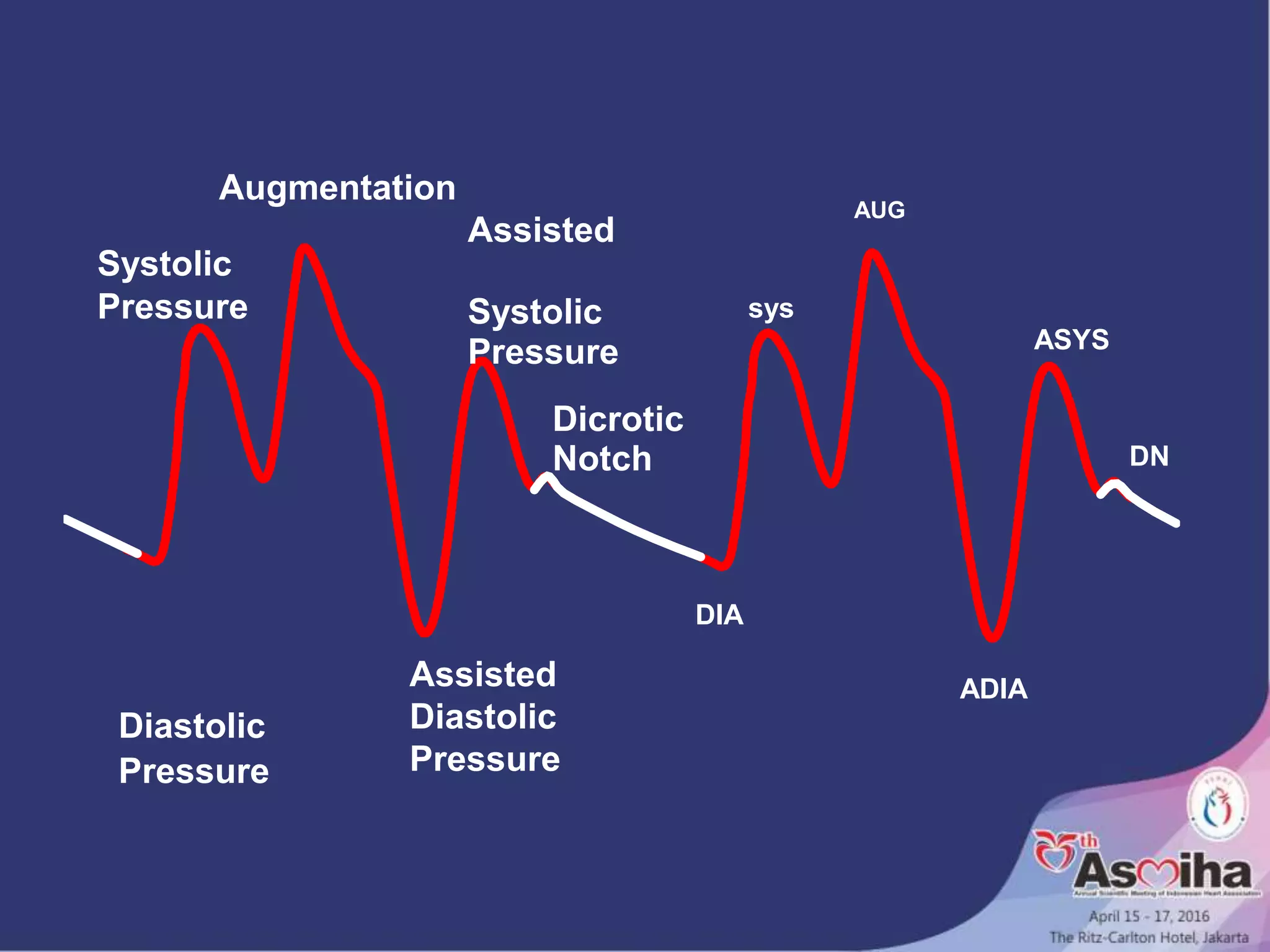 Iabp Principle Hemodynamic Timing Weaning 2016 Background Asmiha
