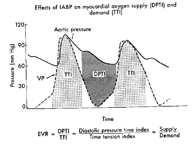 Iabp principle, hemodynamic, timing, weaning 2016 background asmiha ...