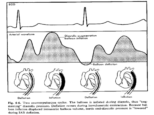 Iabp principle, hemodynamic, timing, weaning 2016 background asmiha ...