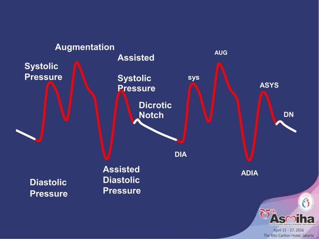 Iabp principle, hemodynamic, timing, weaning 2016 background asmiha ...