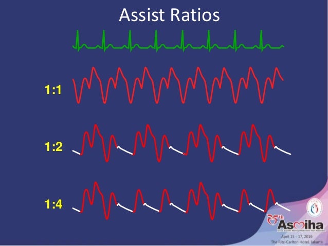 Iabp principle, hemodynamic, timing, weaning 2016 background asmiha,…