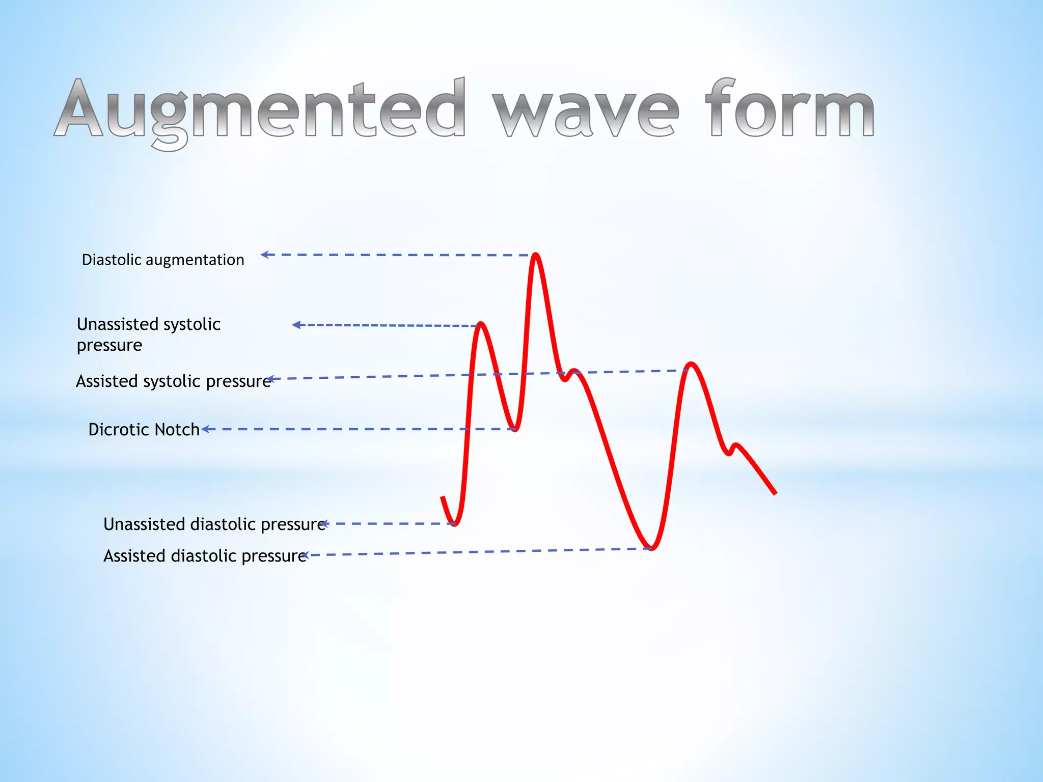 Iabp wave forms | PPTX