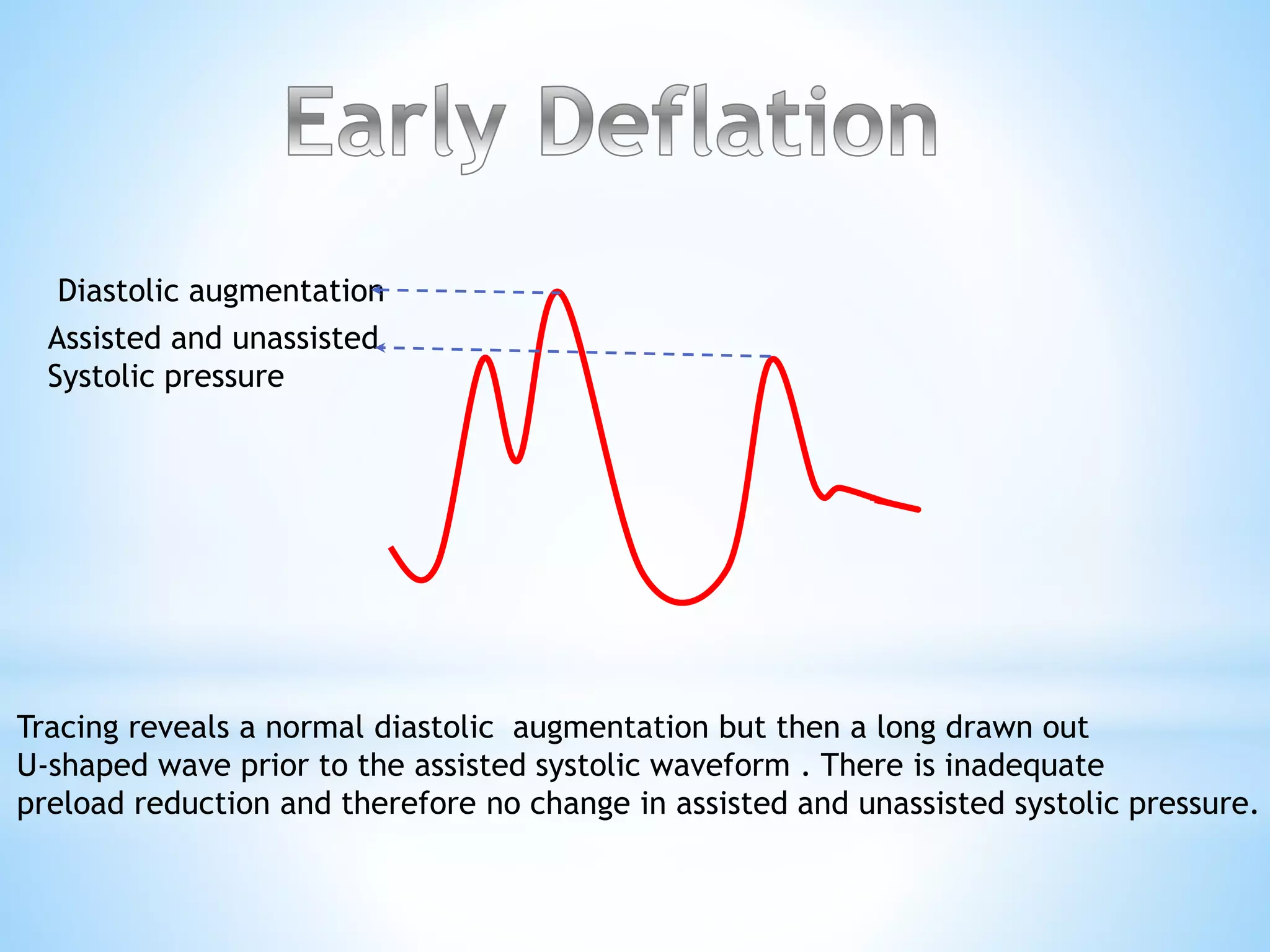 Iabp wave forms | PPTX