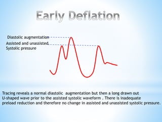 Iabp wave forms | PPTX