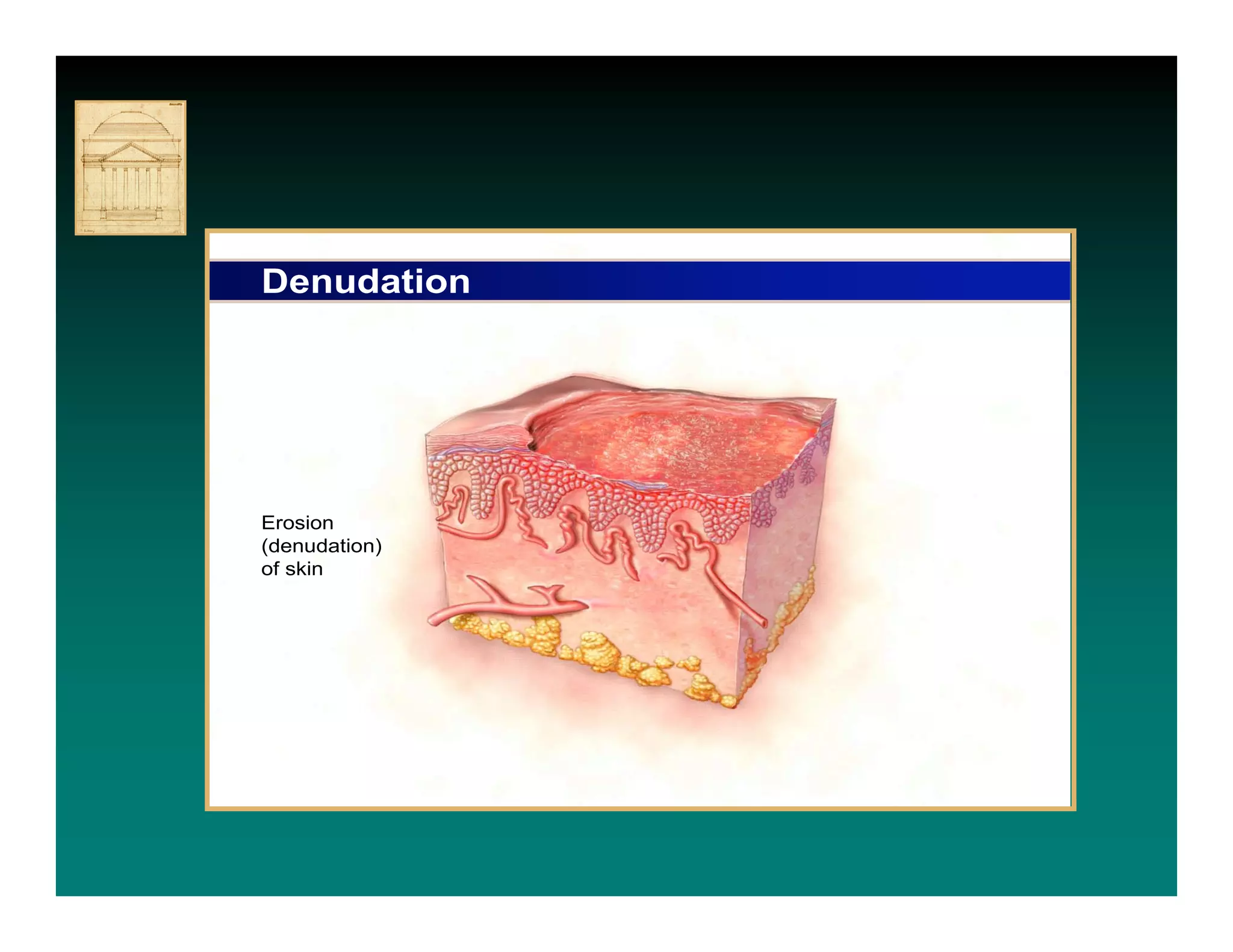 Incontinence Associated Dermatitis by Prof Dr Mikel Gray | PDF