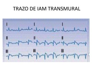 Infarto agudo de miocardio | PPTX