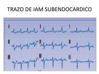 Infarto agudo de miocardio | PPTX