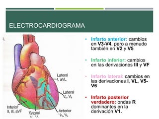 Electrocardiograma De Infarto De Miocardio Lateral