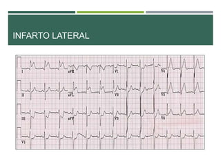 Electrocardiograma De Infarto De Miocardio Lateral