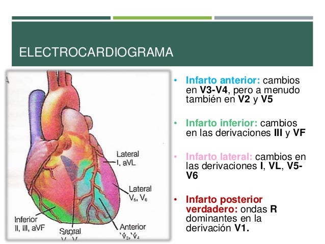 Electrocardiograma Ecg En Infarto De Miocardio Iam