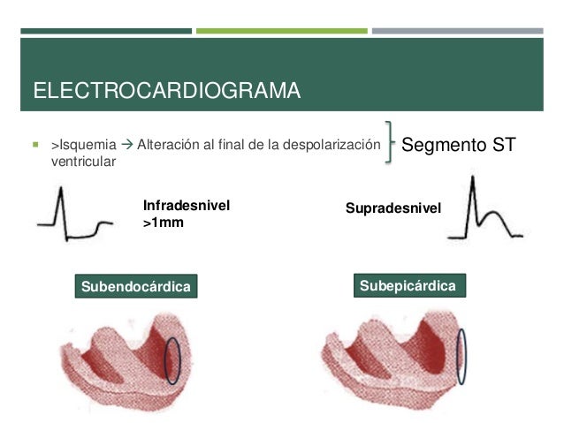 Infarto agudo al miocardio