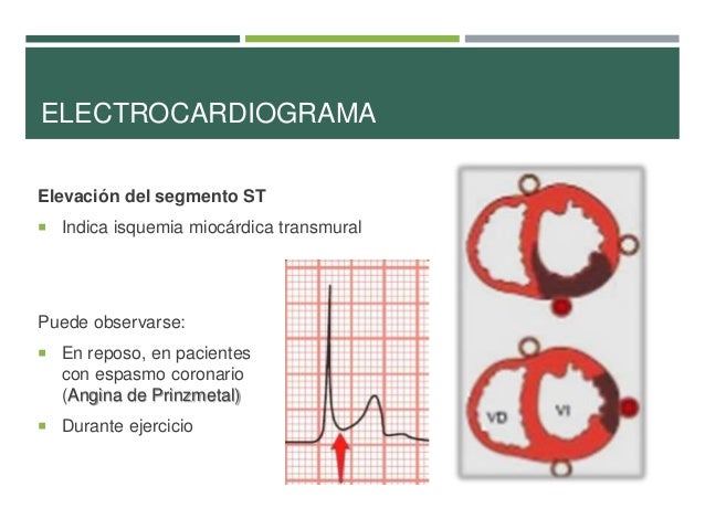 Infarto agudo al miocardio