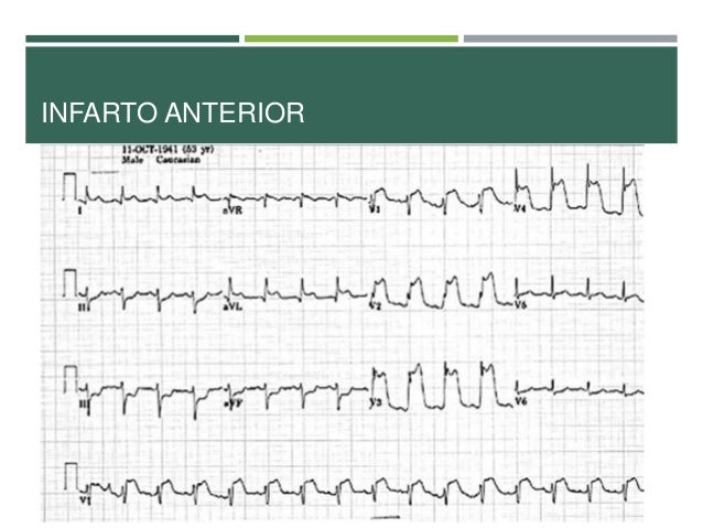 Infarto agudo al miocardio