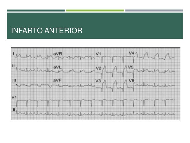 Infarto agudo al miocardio