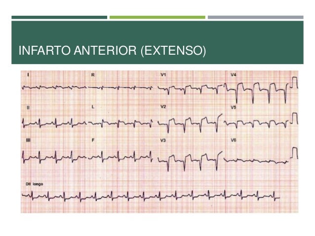 Infarto agudo al miocardio