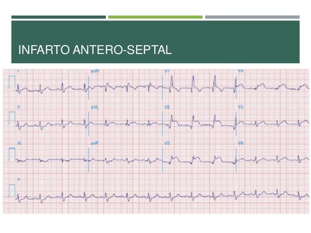 Infarto agudo al miocardio