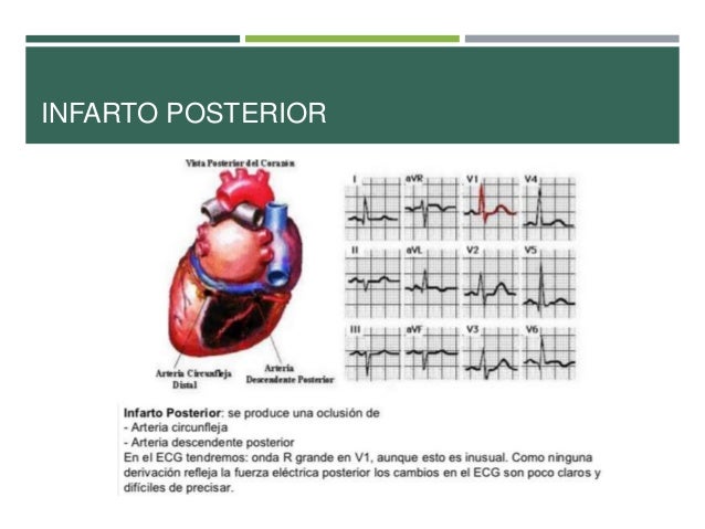 Infarto agudo al miocardio