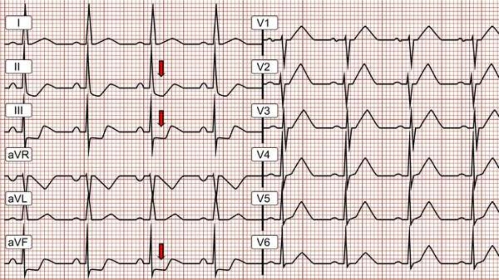 Infarto Agudo de Miocardio sin y con elevación del segmento ST
