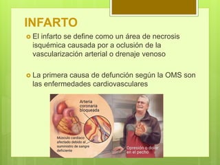 infarto agudo de miocardio | PPTX