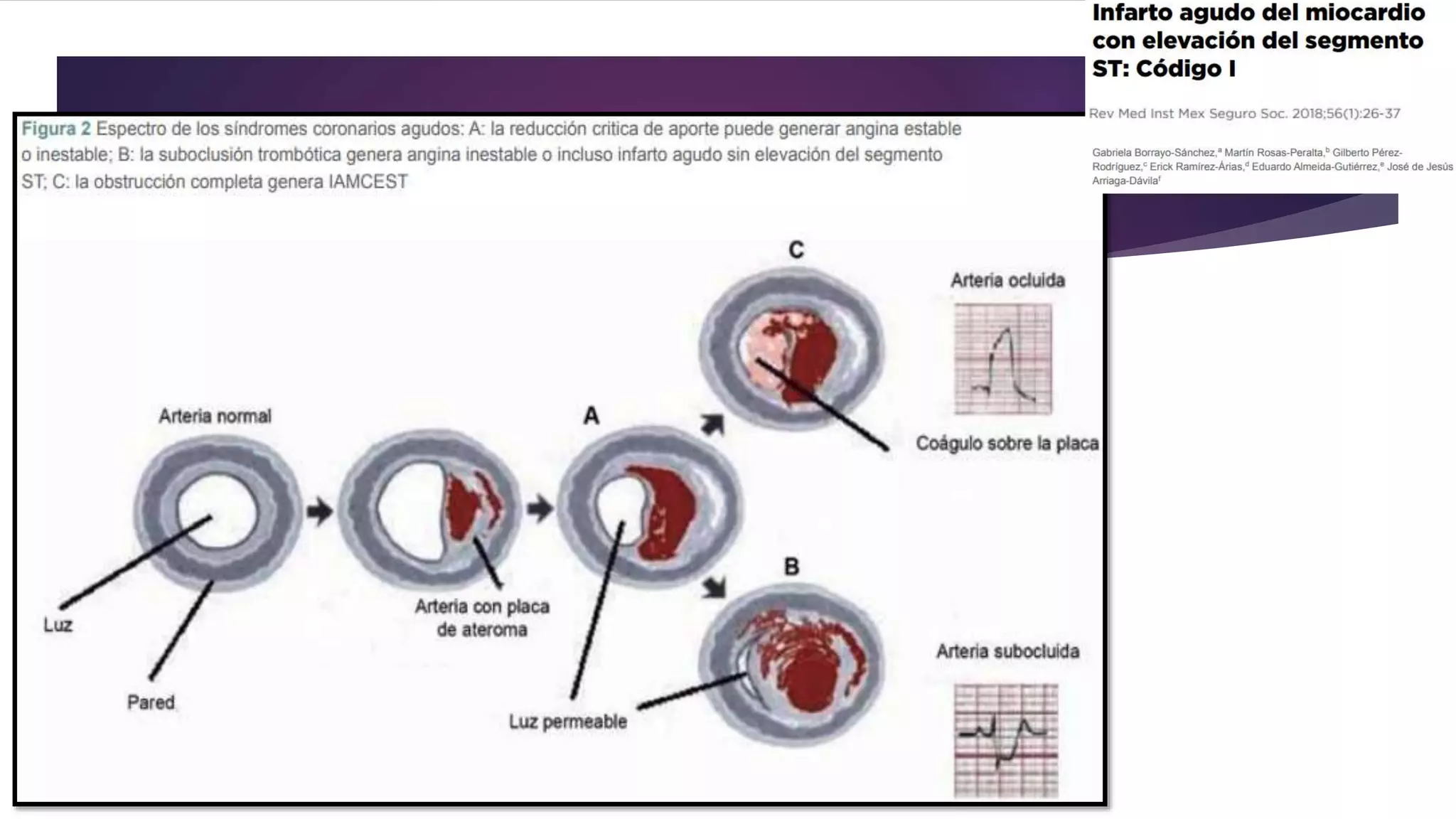 Infarto del miocardio con segmento ST elevado | PPTX