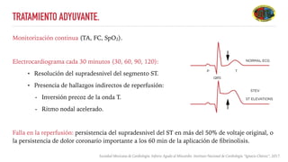 Infarto de miocárdico con elevación ST.pdf
