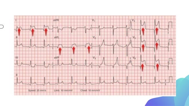 IAM con elevacion del ST