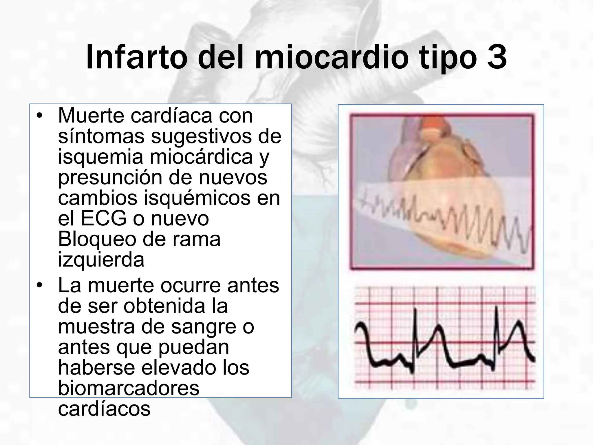 Infarto Agudo Al Miocardio | PPTX