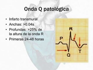 Infarto Agudo Al Miocardio | PPTX