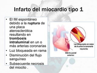 Infarto Agudo Al Miocardio | PPTX