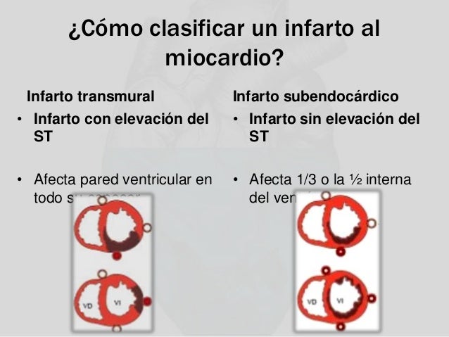 Infarto Agudo Al Miocardio