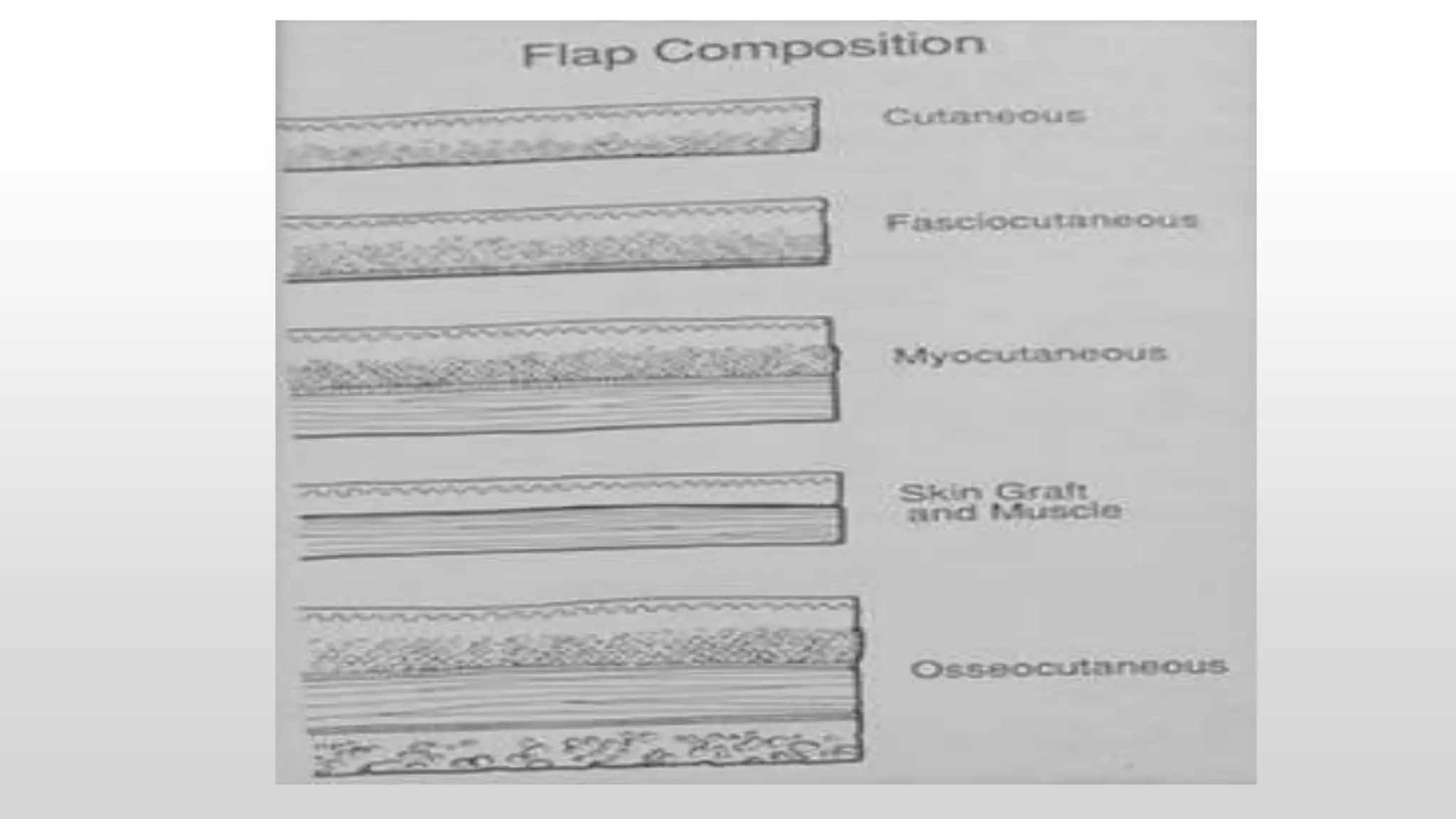Grafts and flaps in head and neck | PPTX