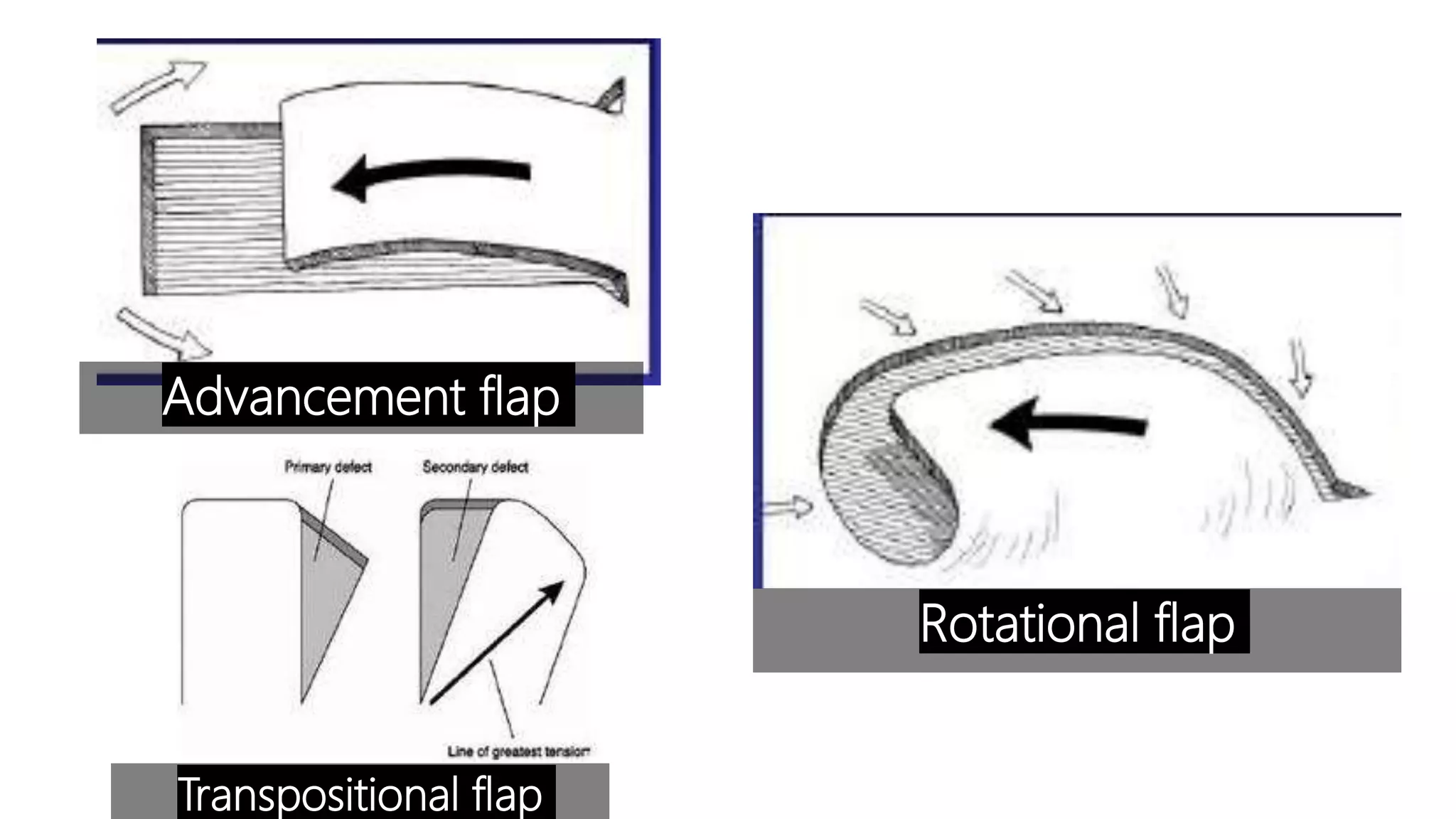 Grafts and flaps in head and neck | PPTX