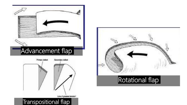 Grafts and flaps in head and neck | PPTX | First Aid | Injuries