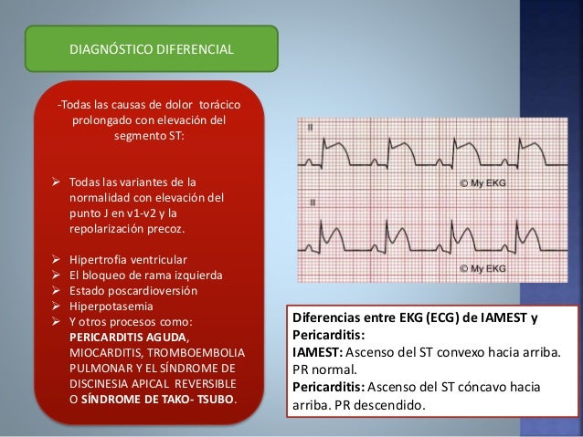 Iam sin elevación del st y con elevación de st