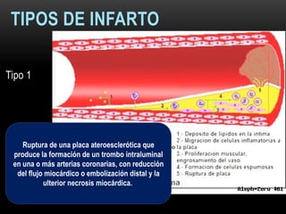infarto agudo del miocardio sin elevacion del st in st.pptx