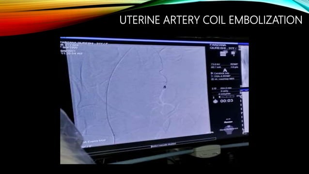Interventional Radiology and Hysterectomy in PPH | PPT
