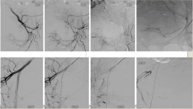 Interventional Radiology and Hysterectomy in PPH | PPT