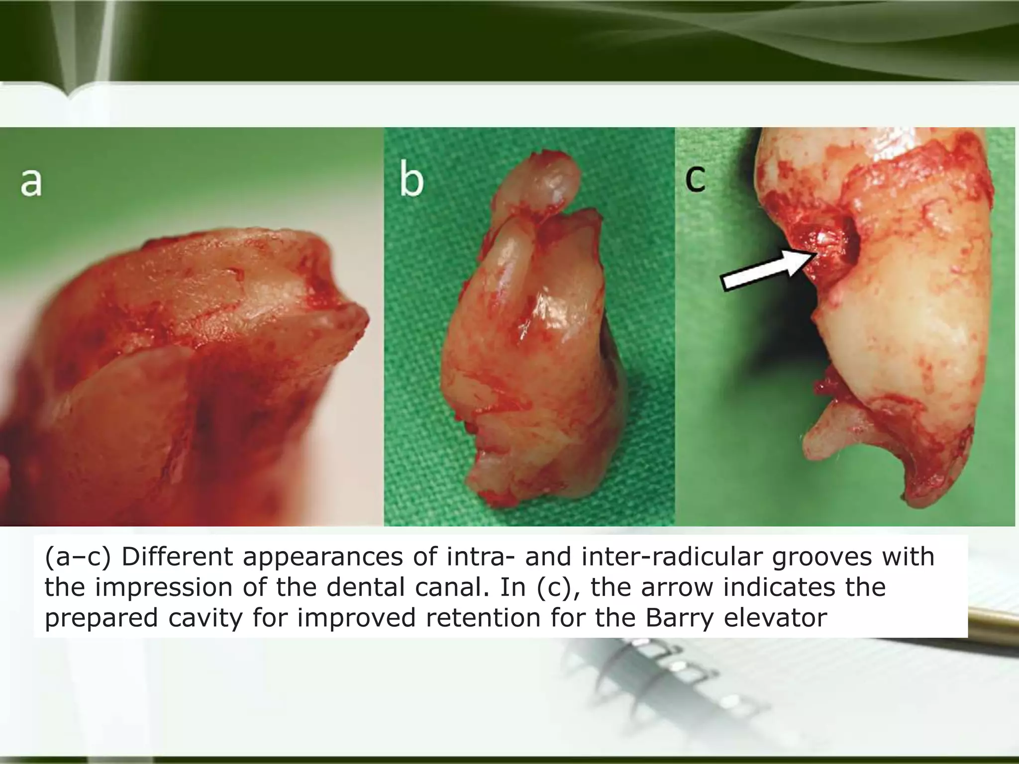 inferior alveolar nerve in opg | PPTX