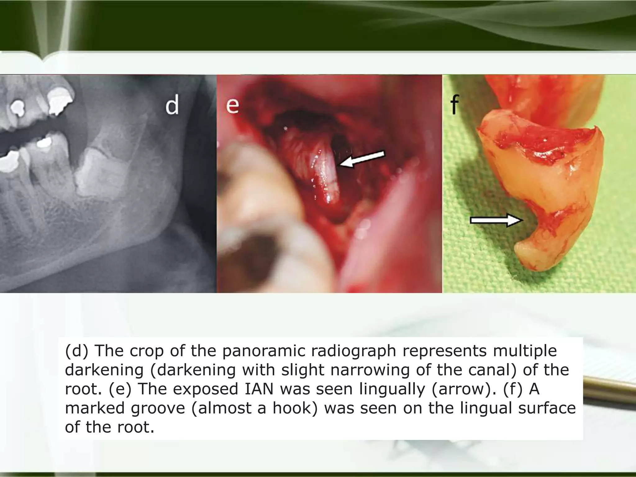 inferior alveolar nerve in opg | PPTX