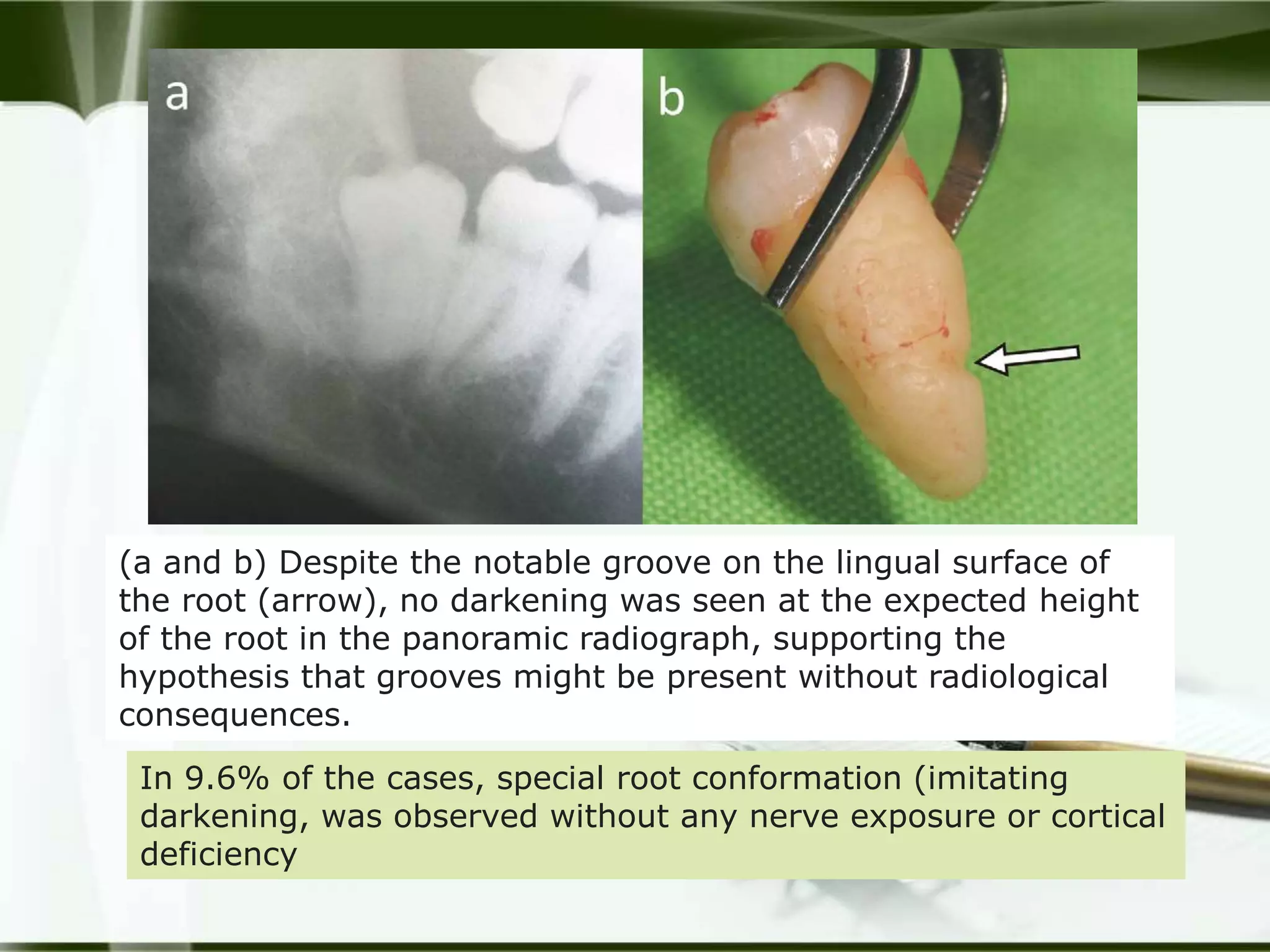 inferior alveolar nerve in opg | PPTX